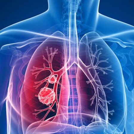 karcinom pluća Archives - Tumor